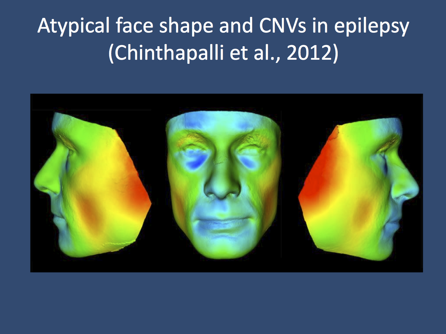 Face to face – atypical face shape and CNVs in epilepsy | Beyond the ...