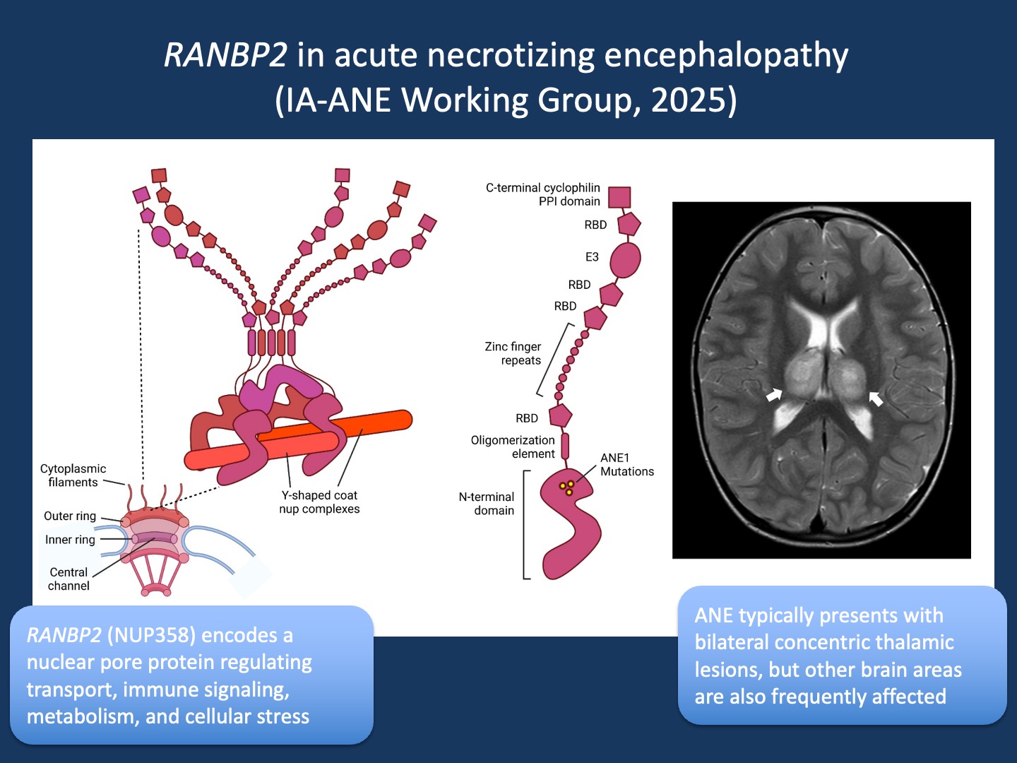 Influenza and acute necrotizing encephalopathy – the genetic dimension ...
